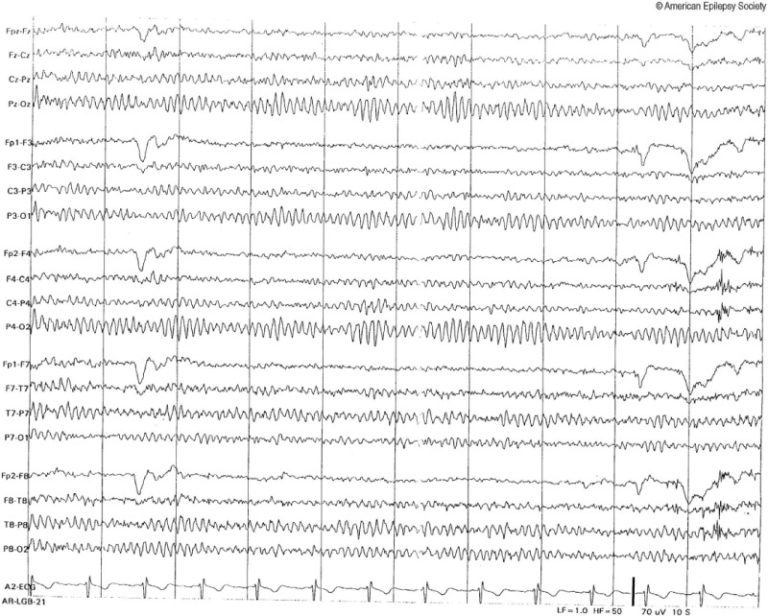 Ambulatory EEG - Neurology Specialists